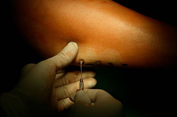 Types of Veins Does a Microphlebectomy Treat