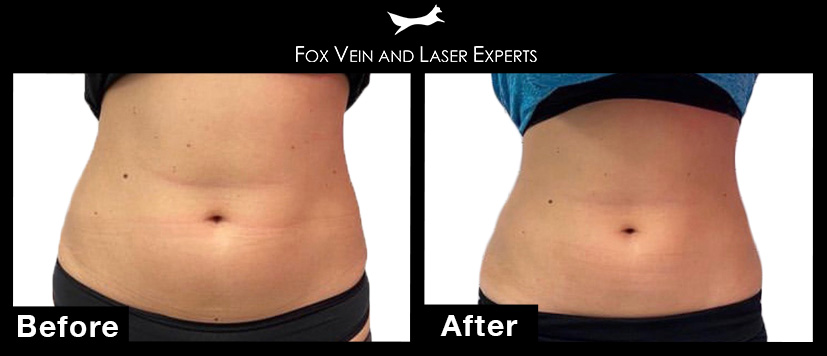 PHYSIQ Body Contouring at Fox Vein & Laser Experts